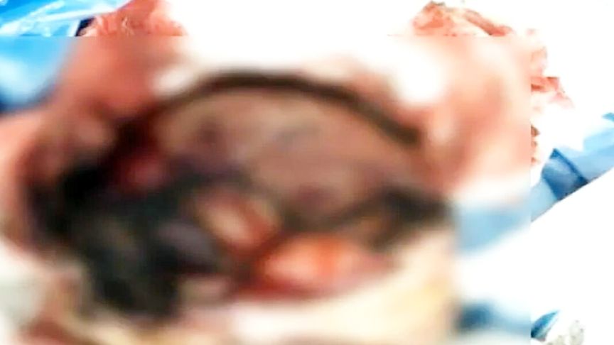 女子被狗咬成重伤转了三家医院,医生一看触目惊心,头皮都被咬掉