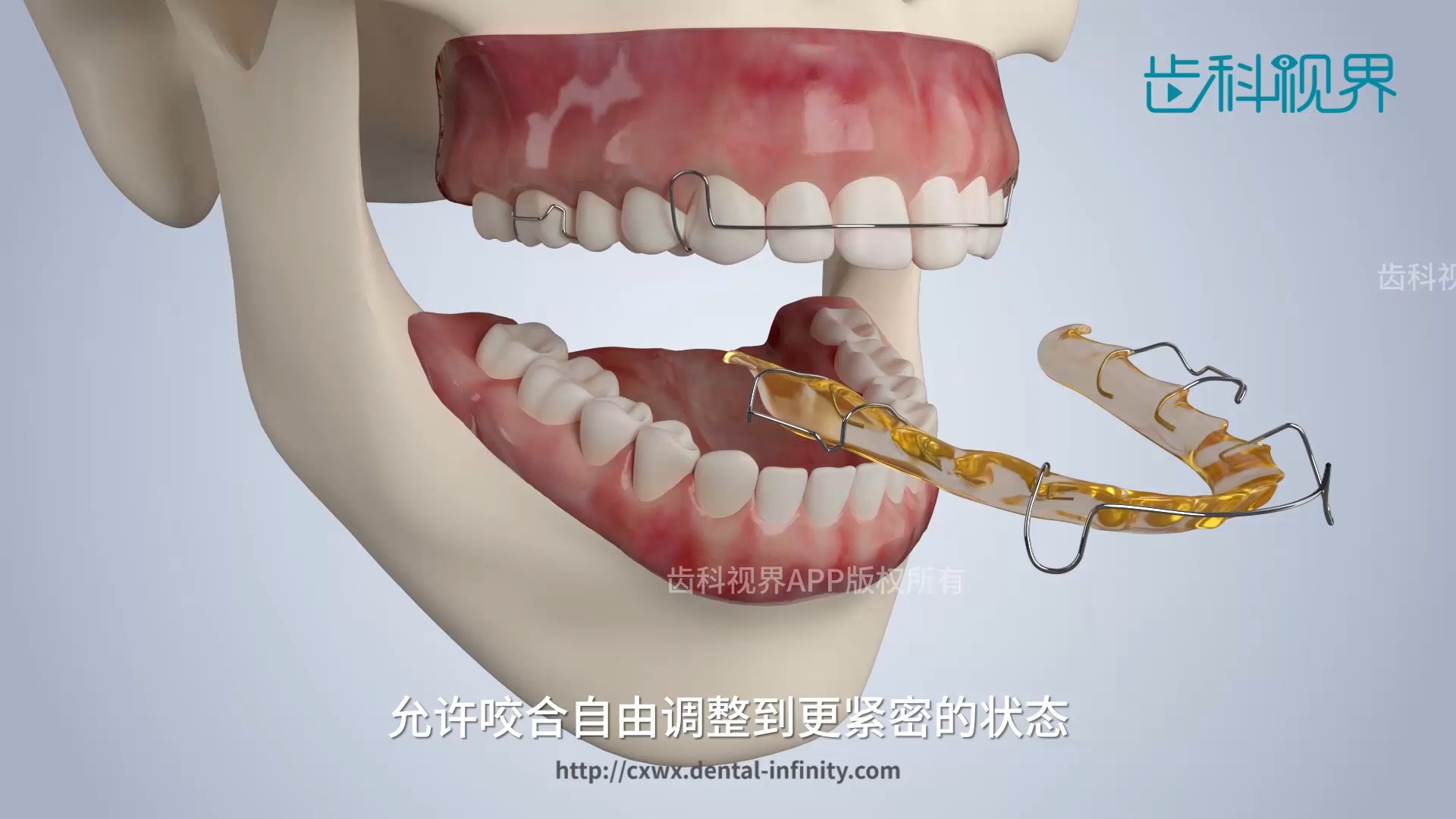 拆除矫治器后注意事项
