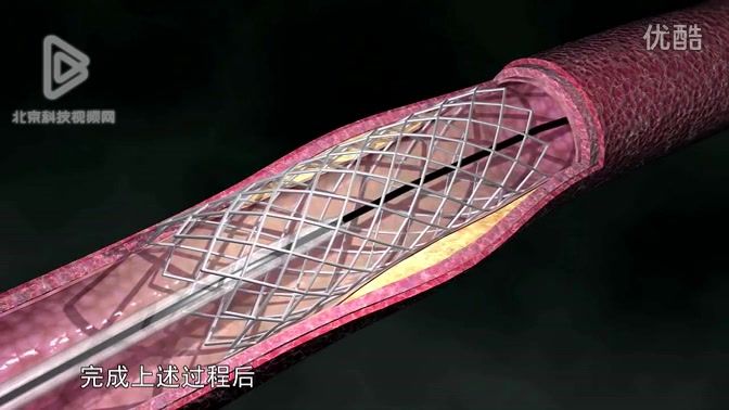 心脏支架是如何放入我们心脏血管的!请看下面的视频动画!