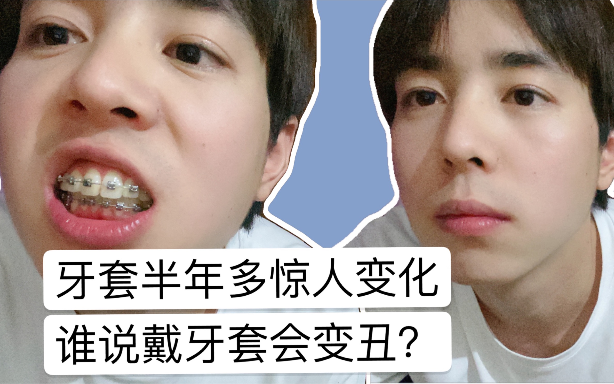 年龄大了不可以戴牙套?23岁开始箍牙,戴牙套半年多,谁说戴牙套会变丑...