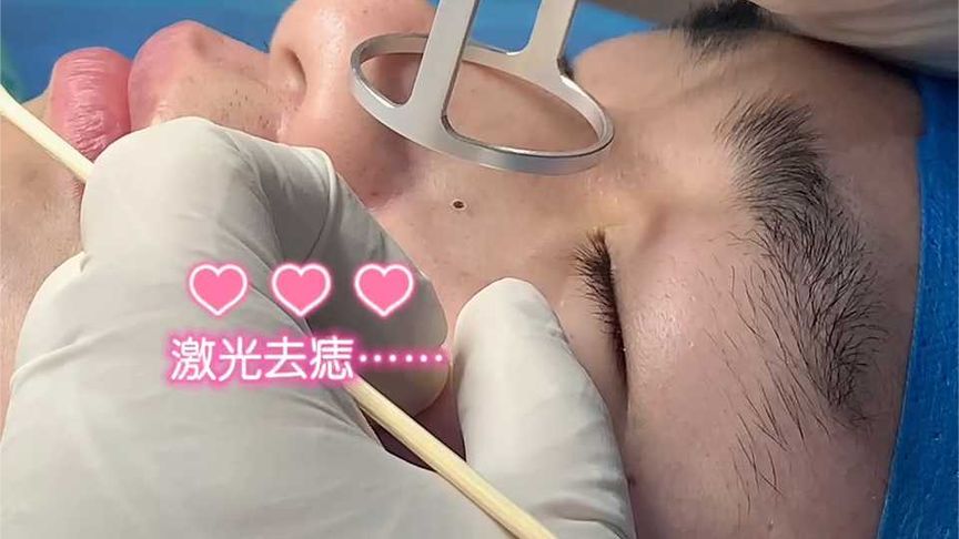 影响颜值的痣该怎么去除?激光去痣中,周主任为你解答