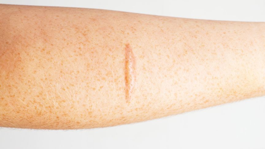 一个伤疤,一个故事。增生性疤痕消退过程要多久?