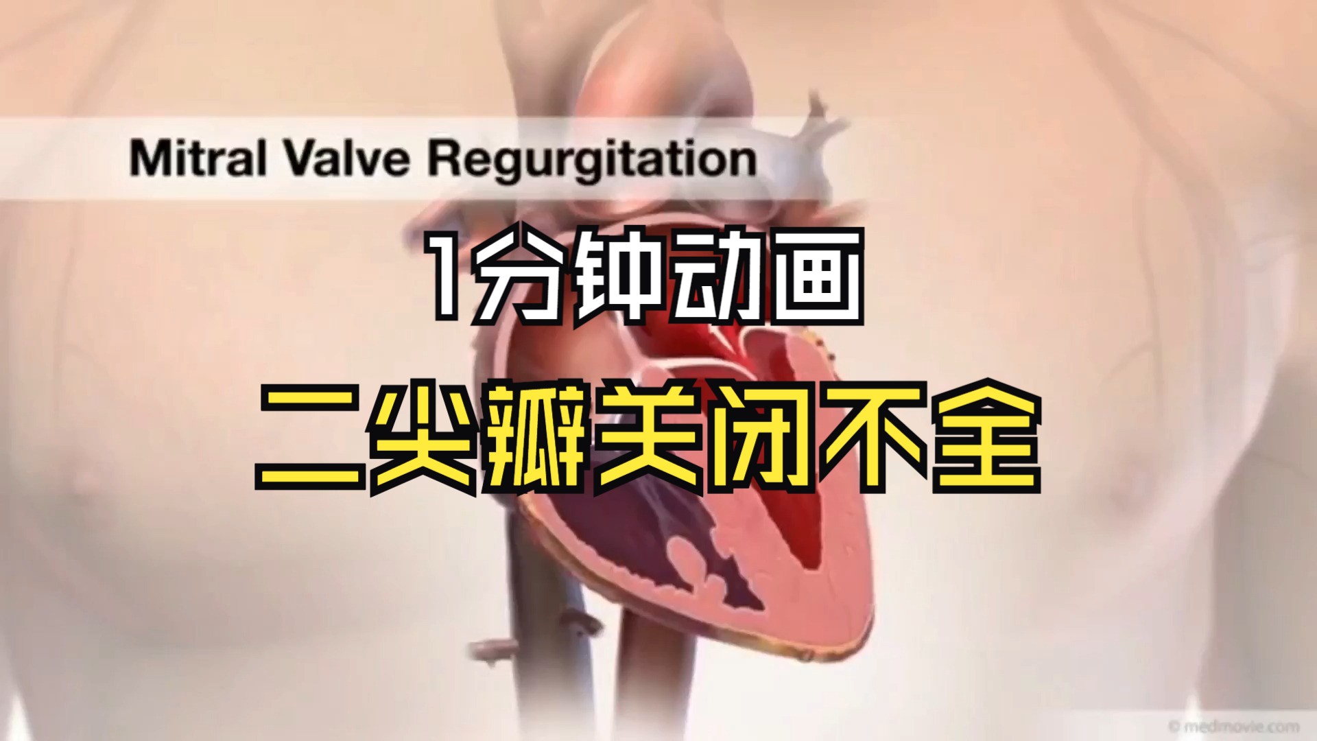 1分钟动画——二尖瓣关闭不全