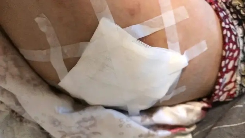 等待是世界上最无奈的爱,脑梗偏瘫褥疮压疮老人的日常护理基本工