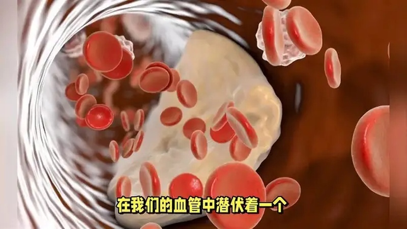 如何知道血管斑块发现斑块怎样消除