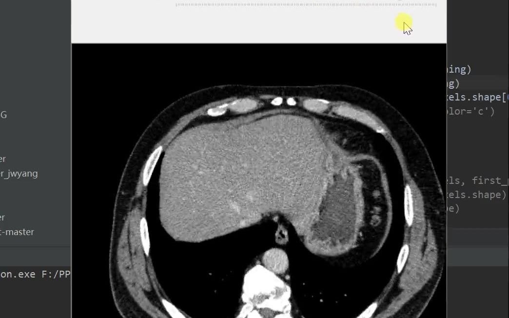 用Pydicom和OpenCV展示腹部CT在不同窗宽窗位的变化