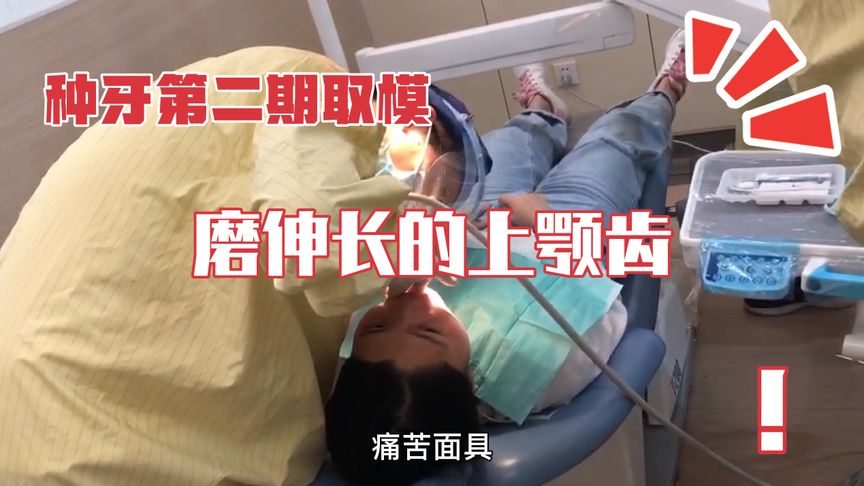 种植牙第二期取模,先磨平向下伸长的上颚齿,第二期费用贵的惊人