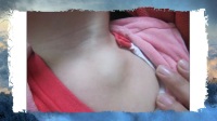 脉管畸形是怎么回事如何鉴别血管瘤和脉管畸形