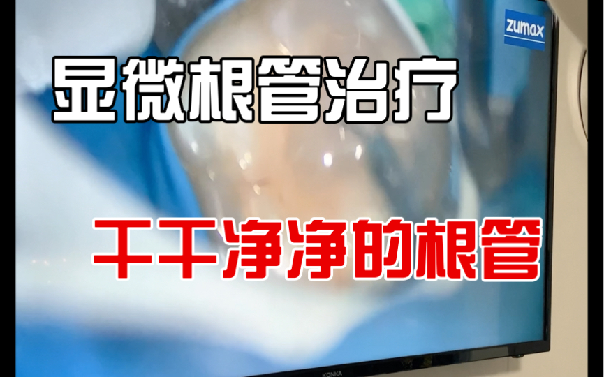 为什么选择显微根管治疗呢,因为干干净净啊。