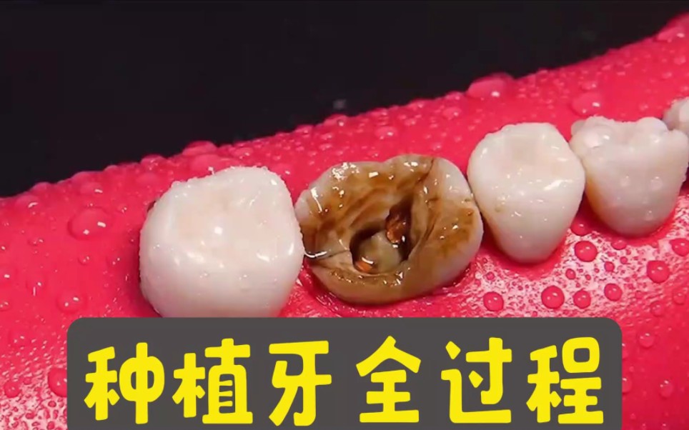带你了解种植牙全过程,疼不疼,需要多长时间,过程很详细。