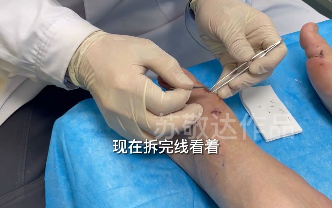 【苏敬达】25岁北京小哥,拇外翻术后2周来拆线,走路没影响