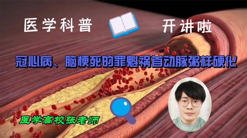冠心病、脑梗死的罪魁祸首动脉粥样硬化,它是什么?由何而来?