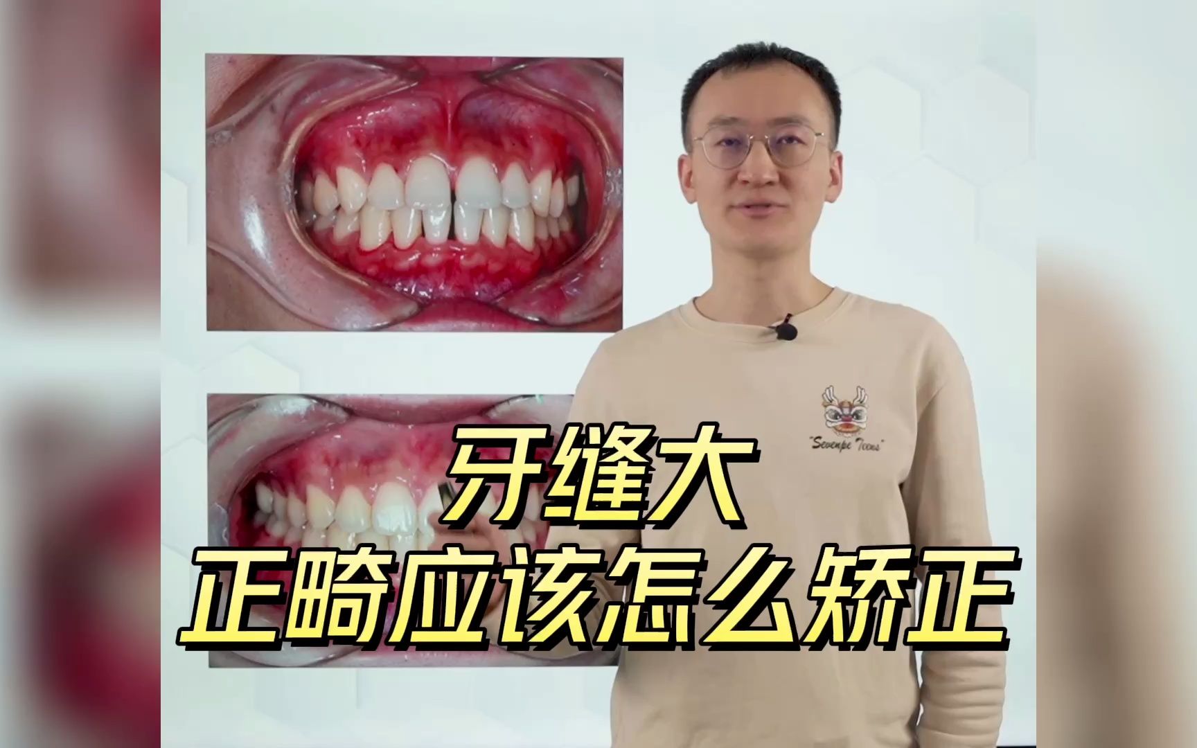 牙缝大正畸应该怎么矫正?没你想的那么简单!