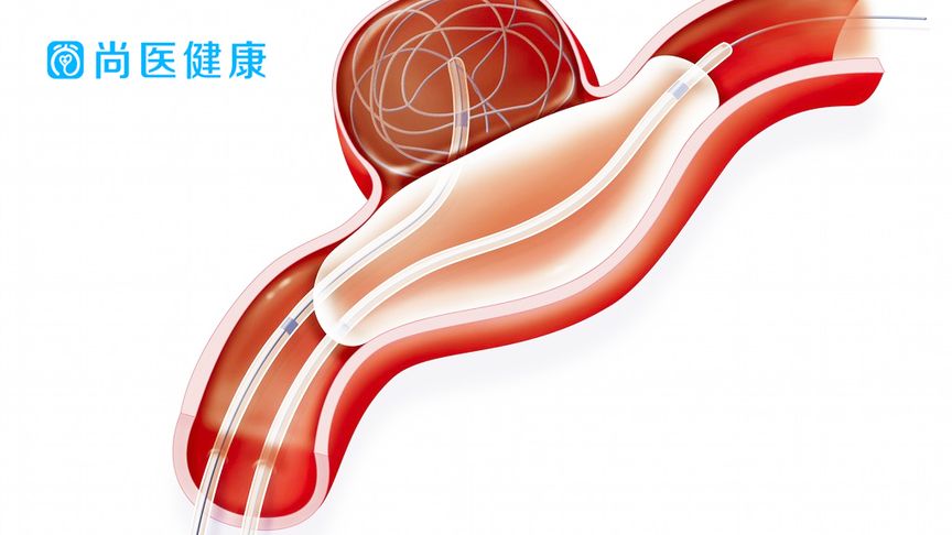 专家揭秘主动脉瘤形成的主要原因!第一个你就想不到!