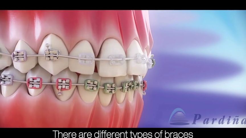 3D演示牙齿正畸矫正的全过程,看着自己都肉疼