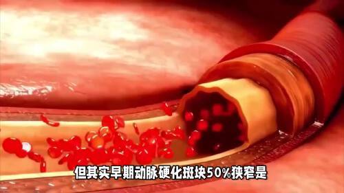 3个月逆转动脉早期斑块!抓住黄金期,用对方法赢回血管健康