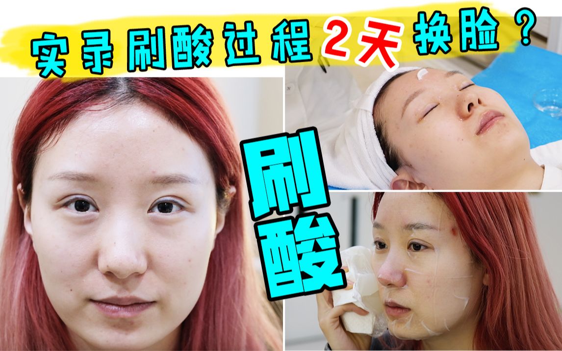不到百元换层皮?实录医美刷酸全过程,怎样刷酸祛痘?油皮、闭口粉刺...