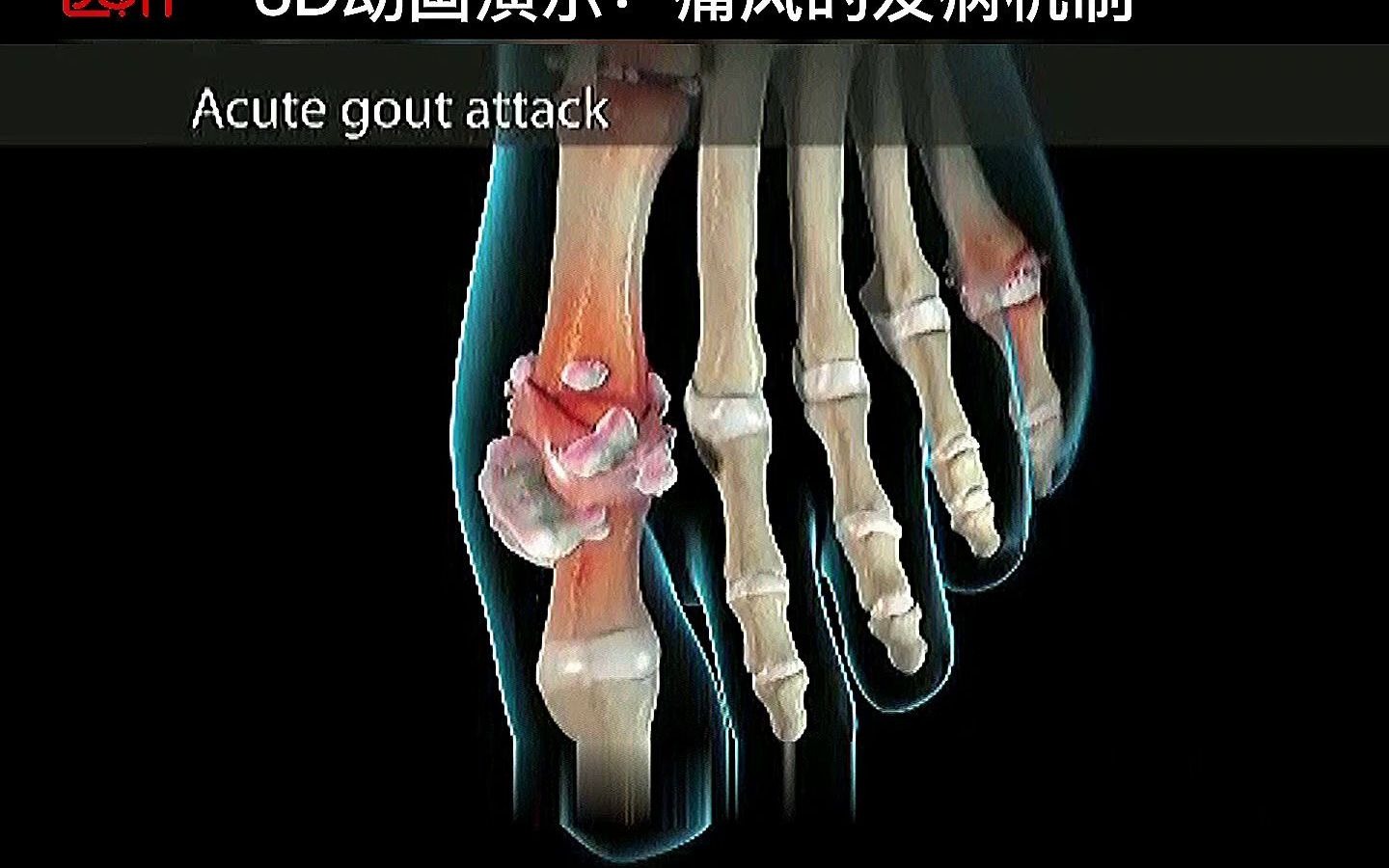 3D医学动画:痛风的发病机制