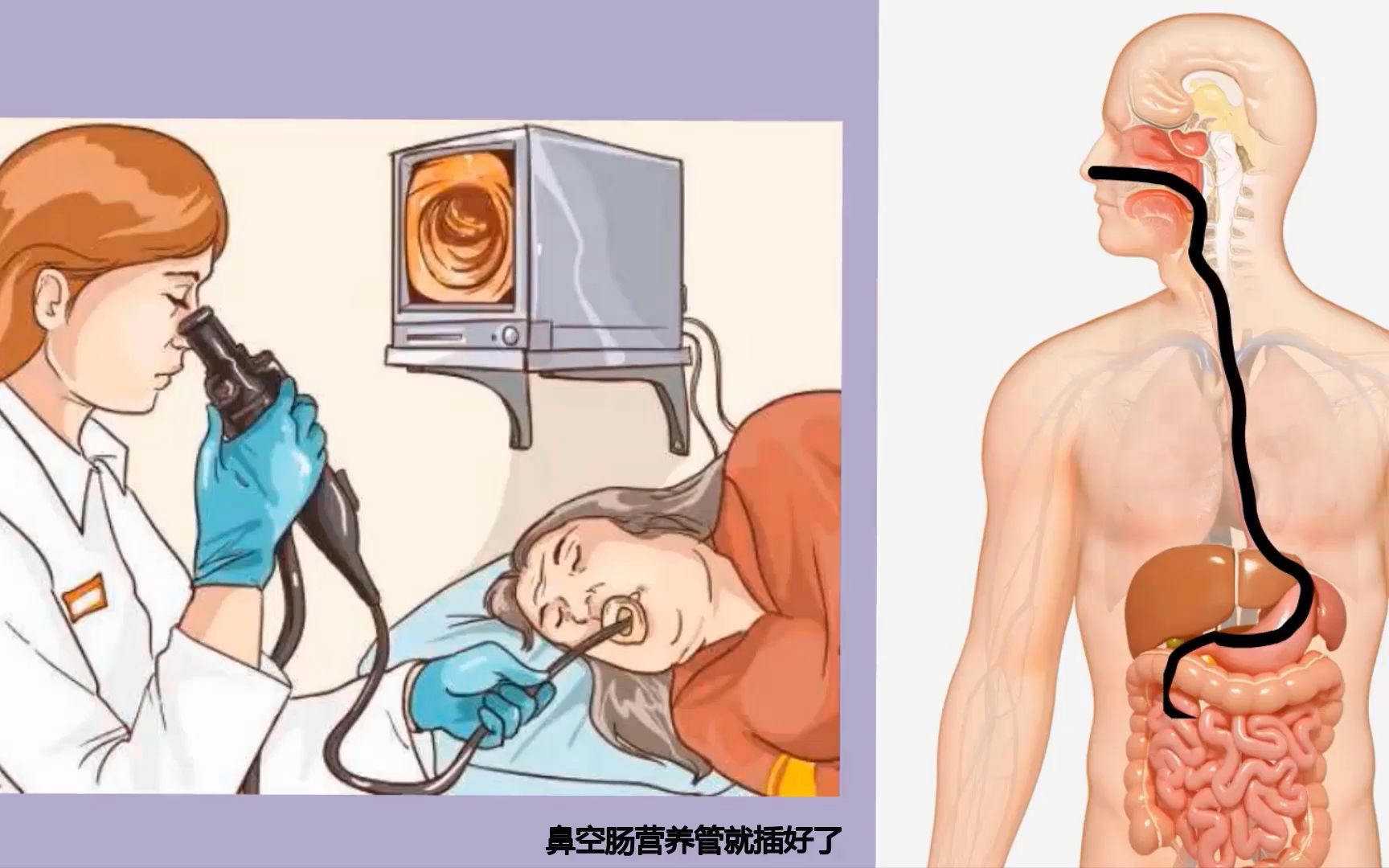 鼻空肠管健康指导