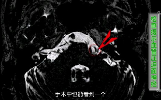 血管压迫面神经会很严重#左侧面肌痉挛#面神经显微血管减压术