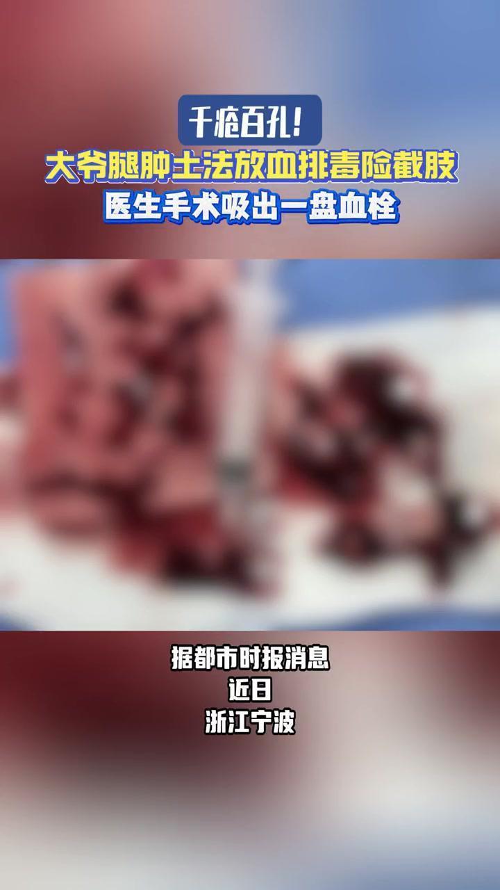 千疮百孔!大爷腿肿土法放血排毒险截肢