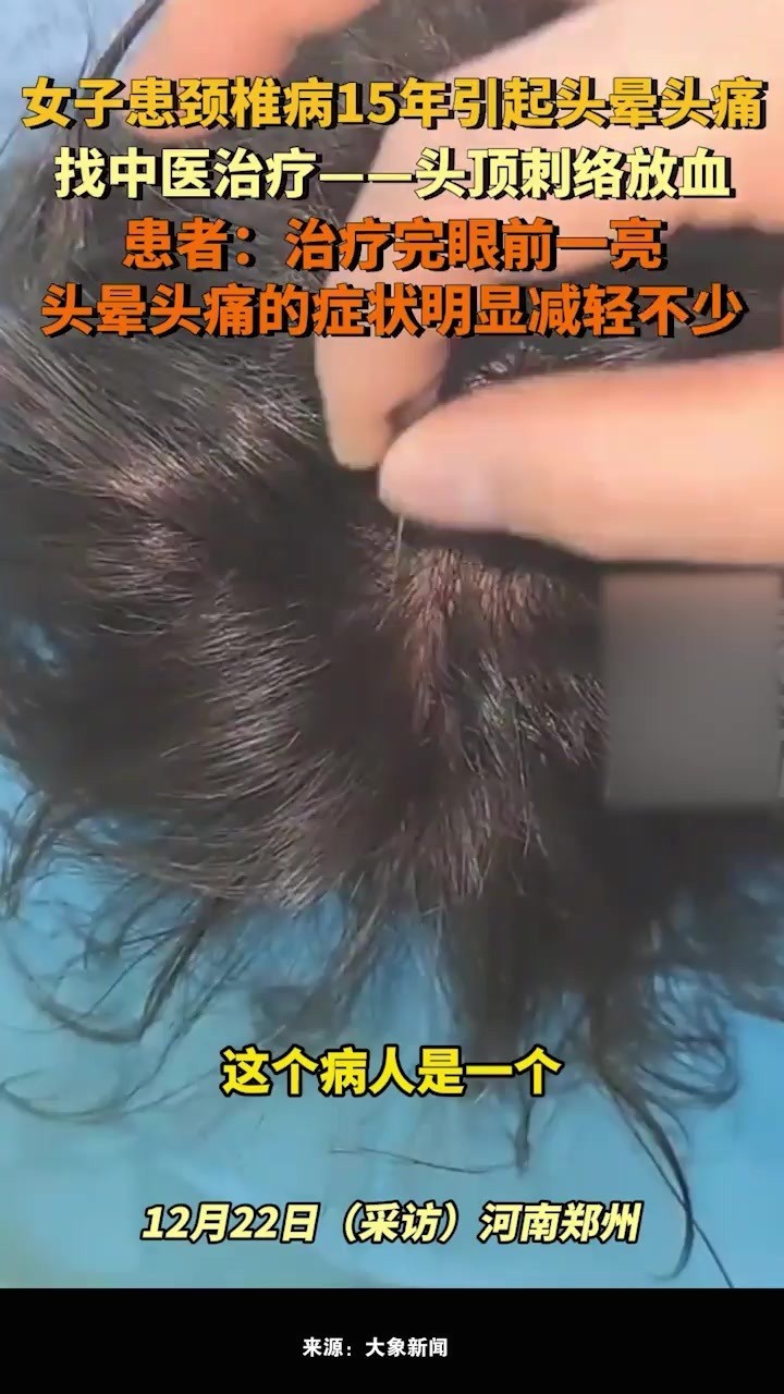 女子患颈椎病15年引起头晕头痛,找中医扎针治疗-头顶刺络放血