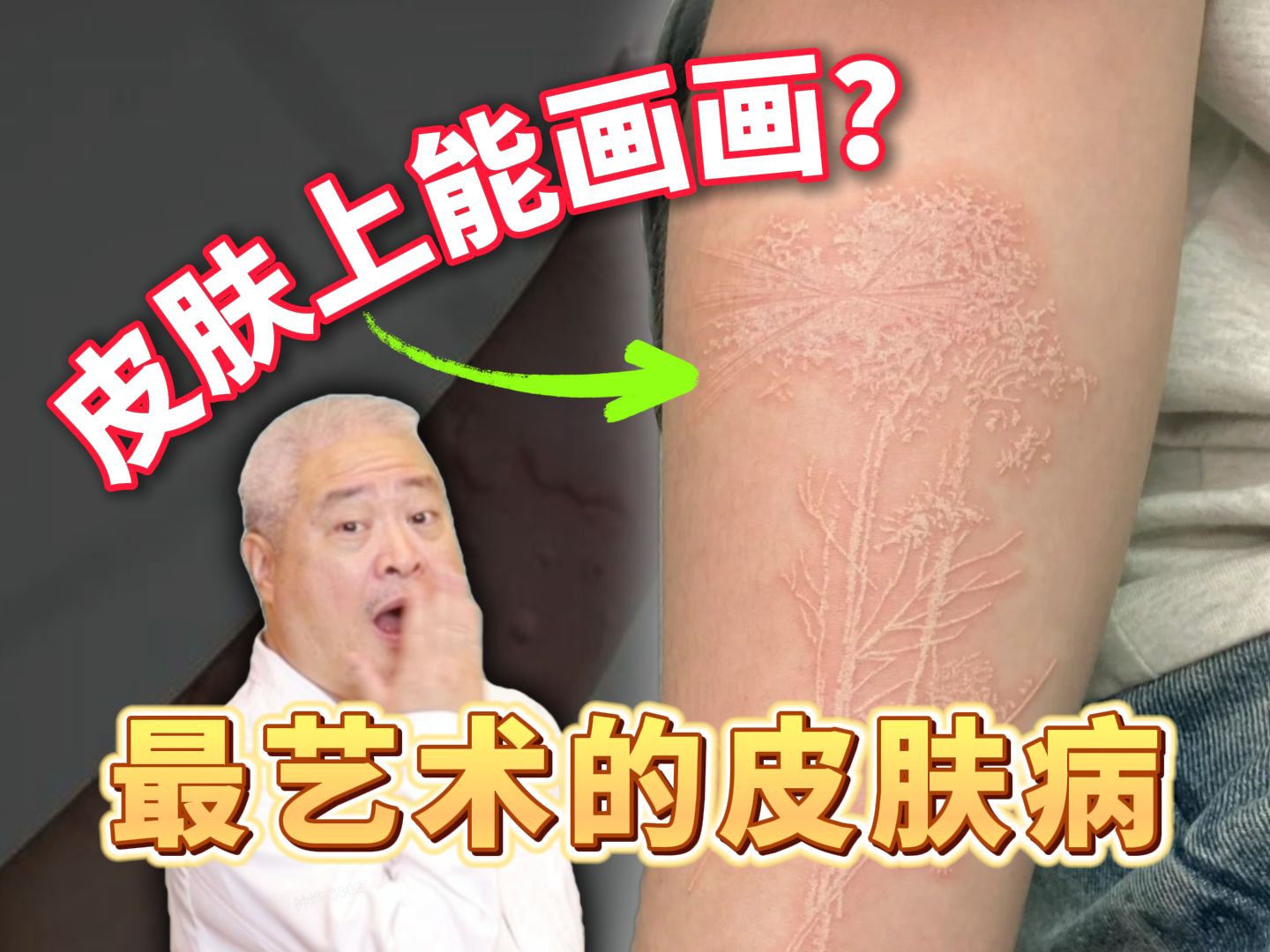 【科普】美术生狂喜!皮肤划痕症:堪称“行走的画板”