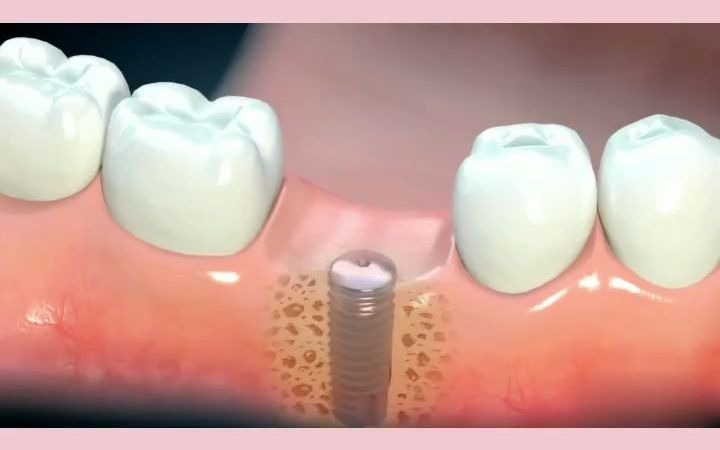 种植牙全过程 #爱牙网#