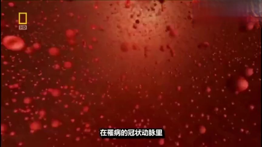 医学3D动画演示:冠状动脉斑块的形成及危害,其中斑块破裂最可怕