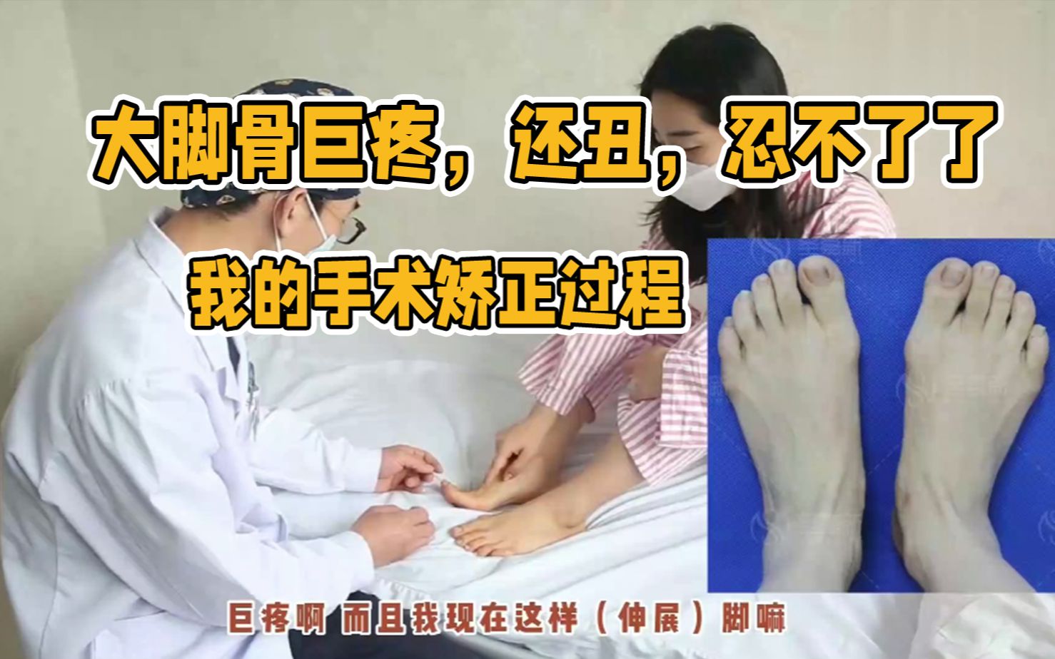 【苏敬达】大脚骨巨疼还丑,做完拇外翻手术,当天就回家了