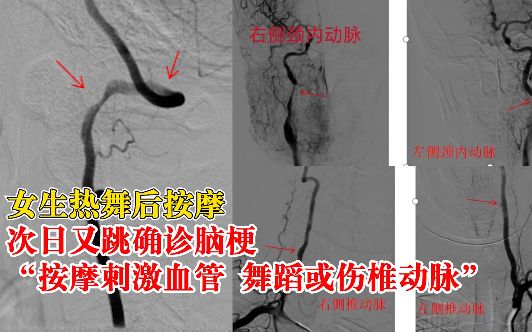 女生热舞后按摩次日又跳确诊脑梗,医生:按摩刺激血管,舞蹈或伤椎动脉