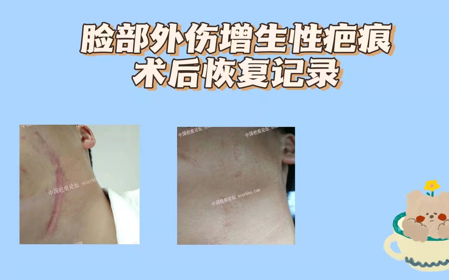 【阿国战疤第13期】脸上增生性疤痕修复记