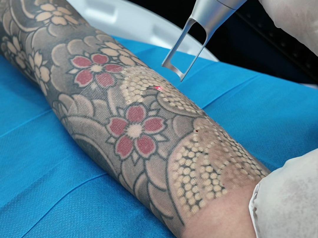 来自安徽的客人,女儿在叛逆期纹了大花臂,现在后悔了,妈妈经过长期...