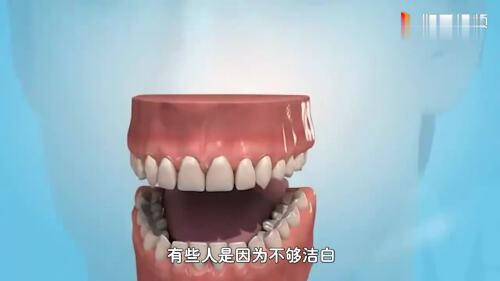 蛀牙真是因为长了虫子?动画模拟生长过程,网友:看着都疼