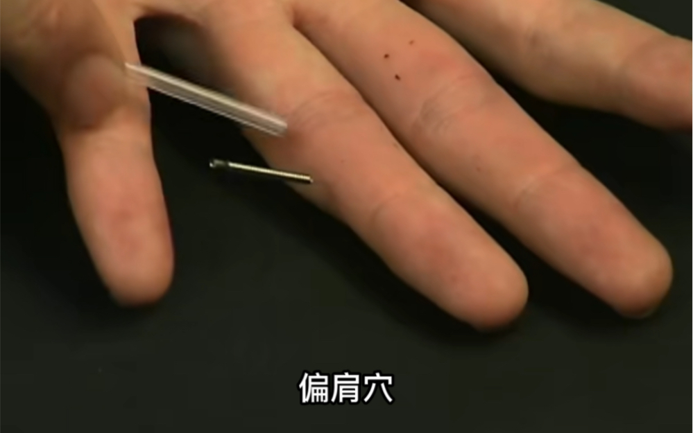 中医人体穴位分布及作用:《偏肩穴》