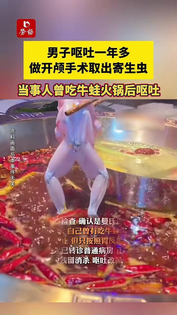 ...取出寄生虫,当事人曾吃牛蛙火锅后呕吐。#寄生虫#手术#曼氏迭宫绦虫