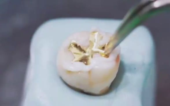 什么是嵌体补牙?模型实嵌体的制备修复过程,牙齿健康实在太重要了!