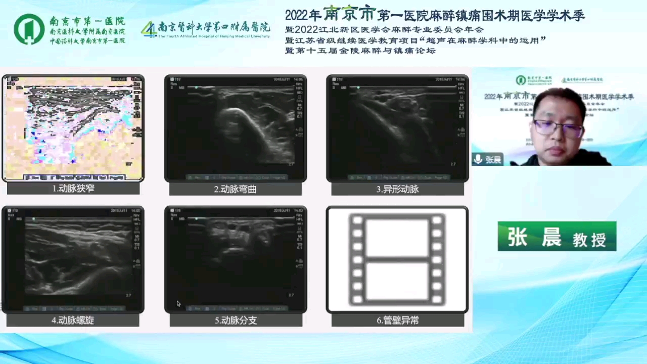 超声引导下血管穿刺