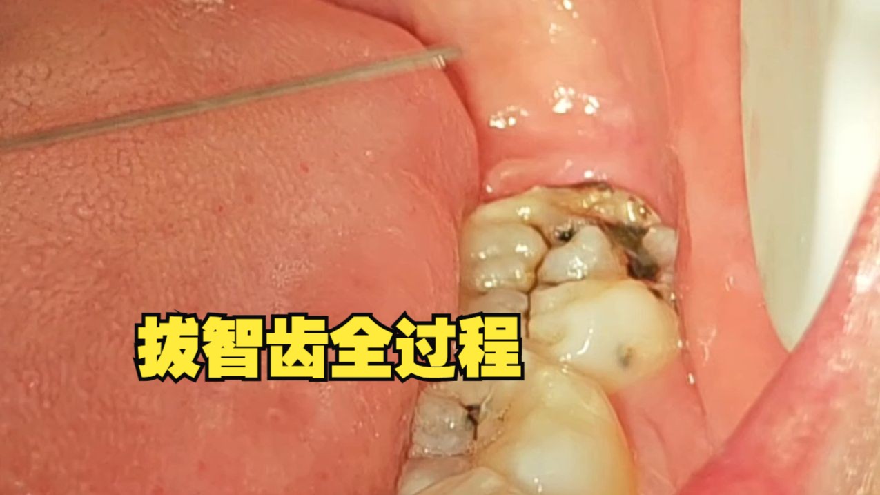 解压视频!拔智齿全过程,只是看看就感受到了酸爽~超解压