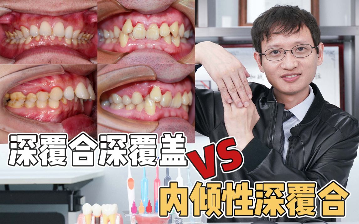 深覆合矫正方案千千万!解锁正确打开咬合方式很重要!