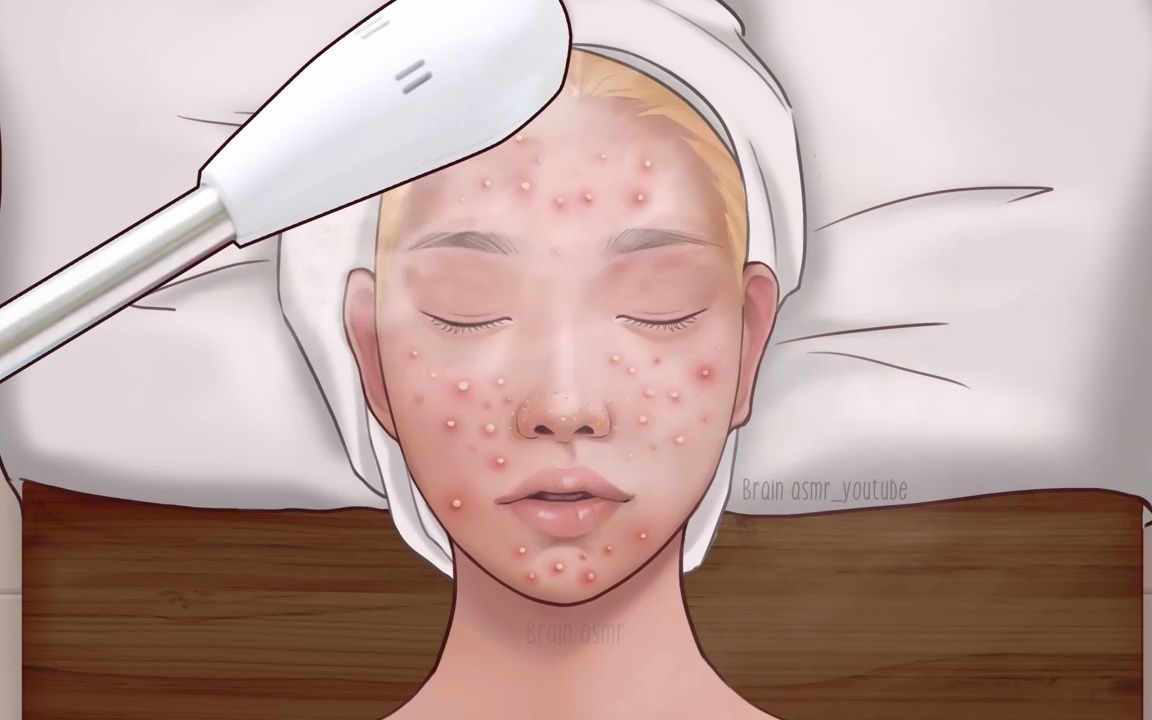 去除腋窝大脓疱和丘疹,手臂下的痤疮动画