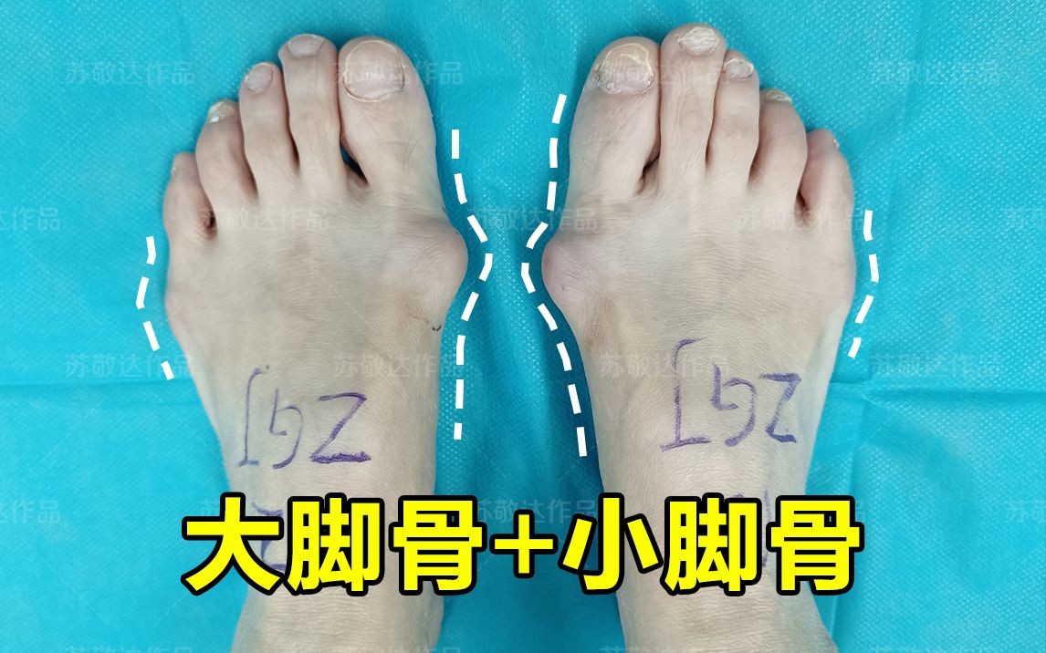 【苏敬达】大小脚骨微创手术彻底吗?效果真香!比传统手术好多了