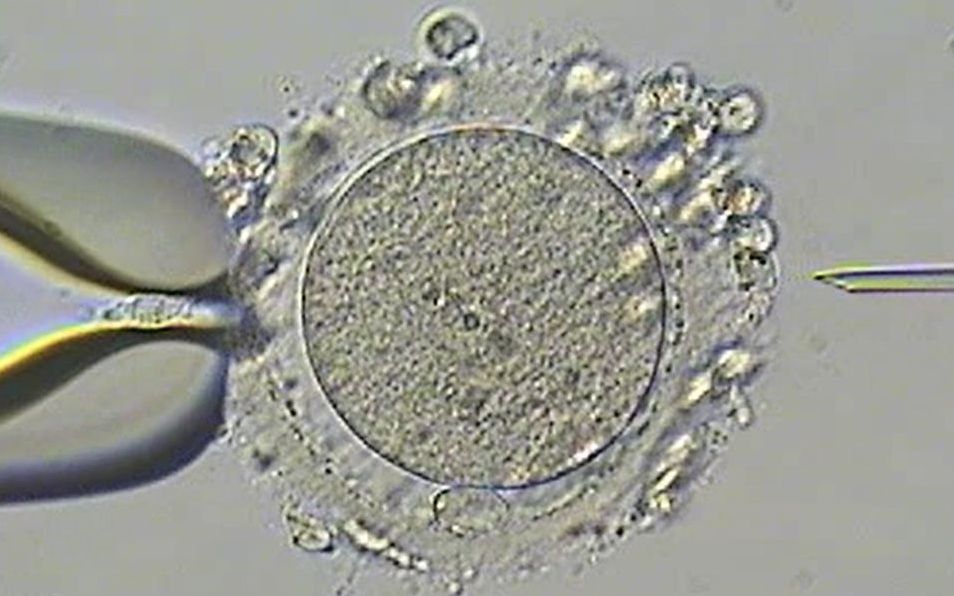 第二代试管婴儿ICSI,卵胞内单精子注射。看看1973年49岁高龄的2个卵...
