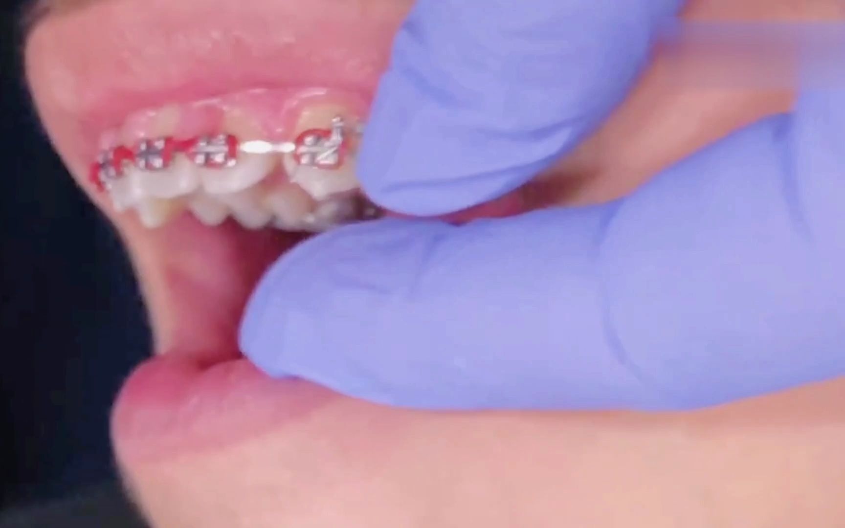 你知道正畸弹簧(拉簧)的作用吗?