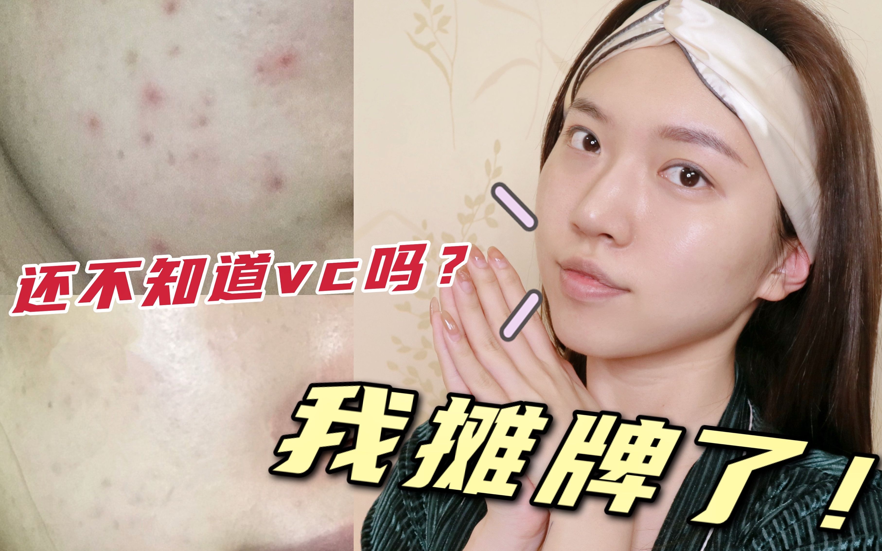 【薇哥】都说vc能美白?到底怎么用?| 痘印克星!