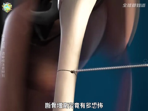 矮个子怎样快速增高断骨增高究竟有多恐怖!