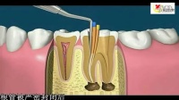 根管治疗全过程