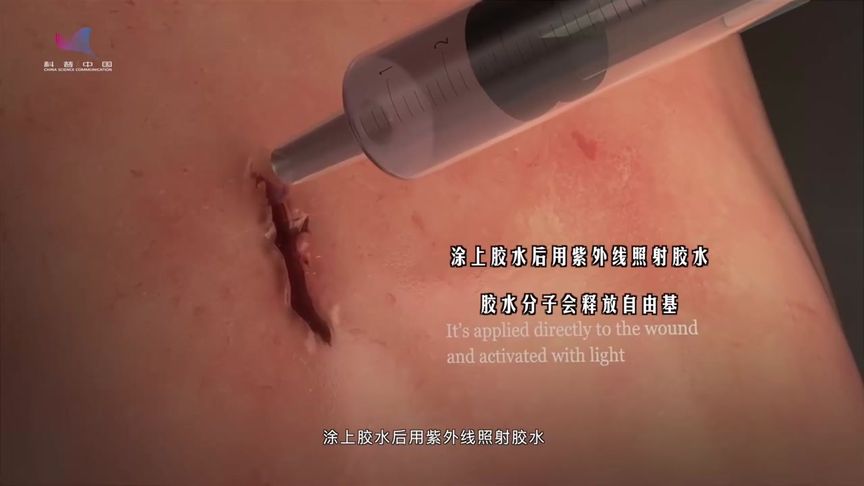 如何“修补”人体组织的伤口?医用超级胶水来帮忙