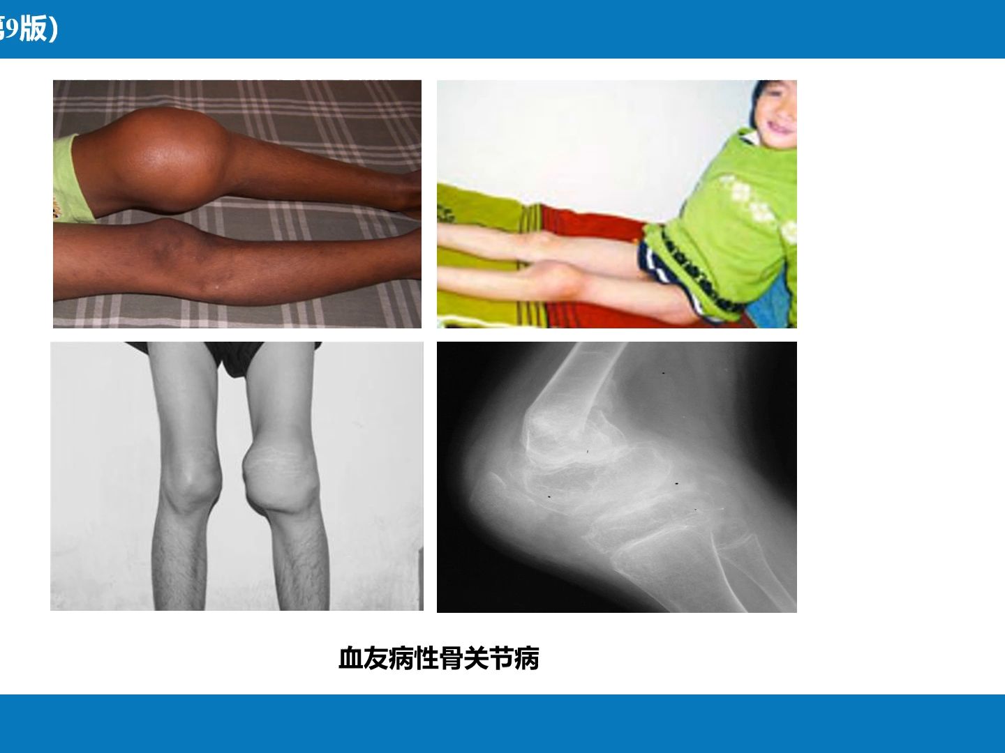 造血系统疾病PPT