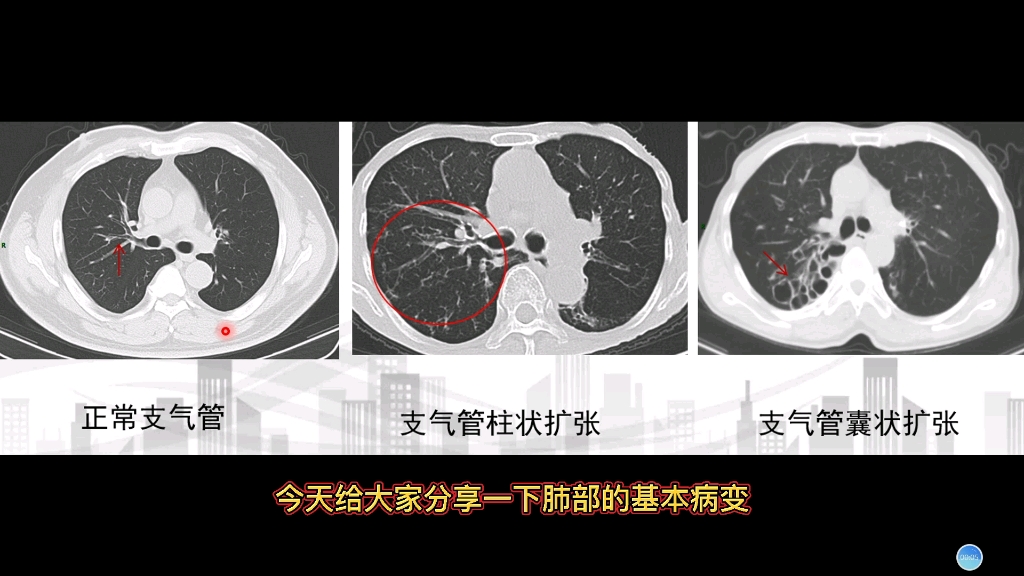 肺部基本影像科普:支气管及支气管扩张在CT上的典型征象!
